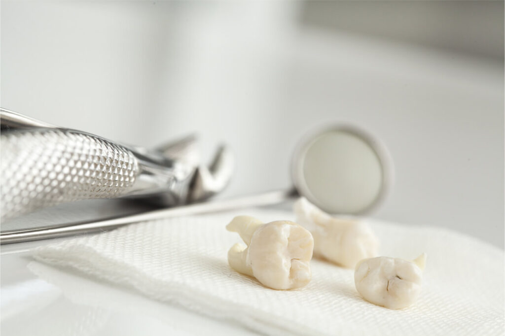 Infection after Wisdom Teeth Removal: What to Do
